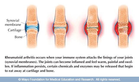 Rheumatoid Arthritis Treatment