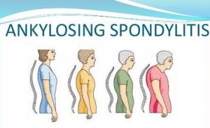 Treatment for Ankylosing Spondylitis - Arthritis Treatment