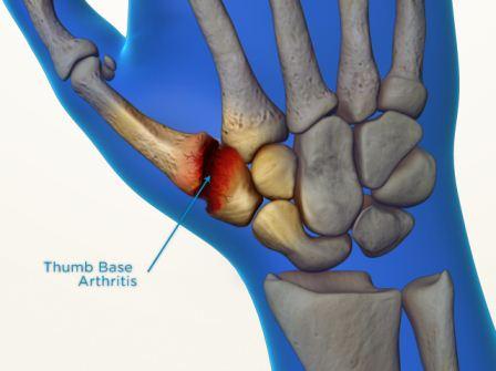 Thumb Arthritis