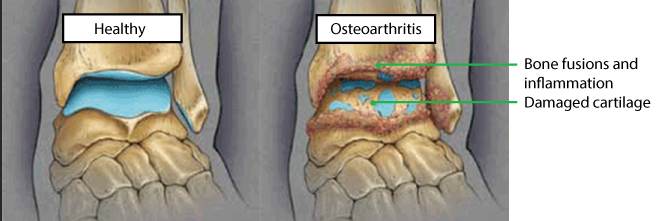 Arthritis in the Ankles - Arthritis Treatment