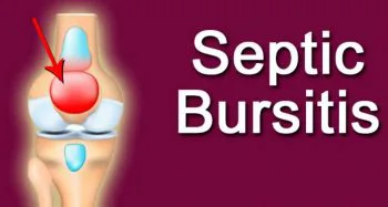 #1 Natural Treatment of Bursitis - Tronchanteric Bursitis